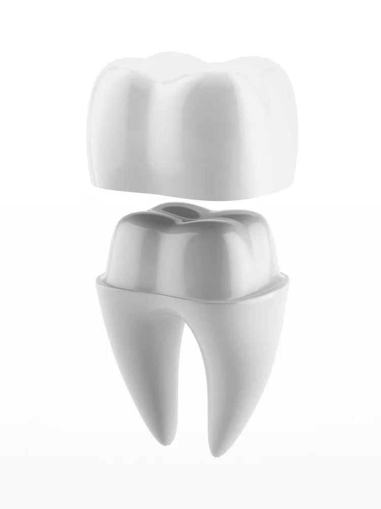 Dental Crown Complications in Beverly Hills CA - Beverly Hills ...